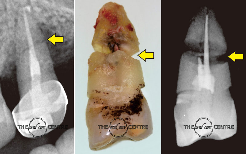 Dental Injuries in Adults & Seniors: A Guide in Singapore