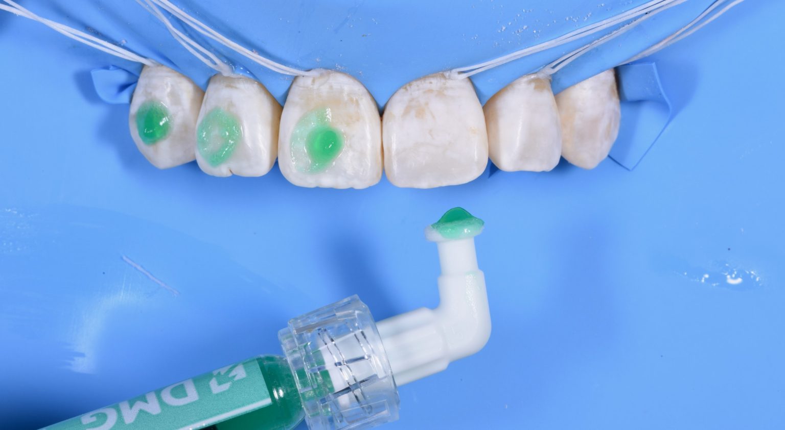 Tooth Discoloration in Singapore: Causes & Prevention